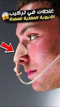 🚫 غلطة صغيرة في تركيب الـ NG Tube ممكن تــ.ـقتل المريض! – NG Tube Placement Gone Wrong