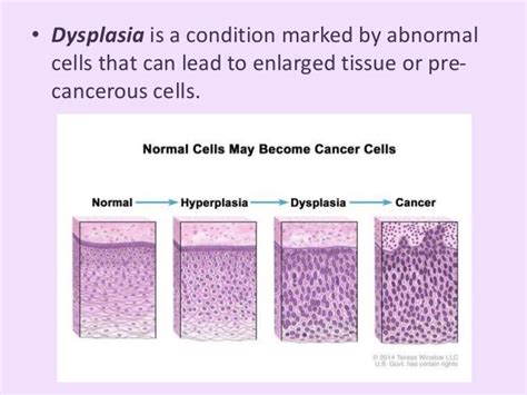 Metaplasia And Dysplasia