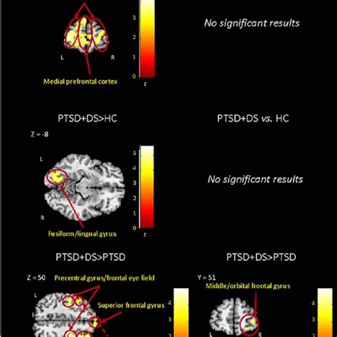 Fig Ure 2 Between Group Resting State Functional Connectivity Results