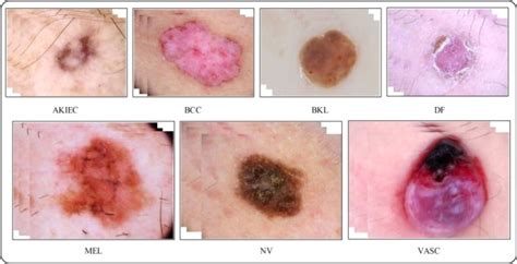 A Novel Framework Of Multiclass Skin Lesion Recognition From