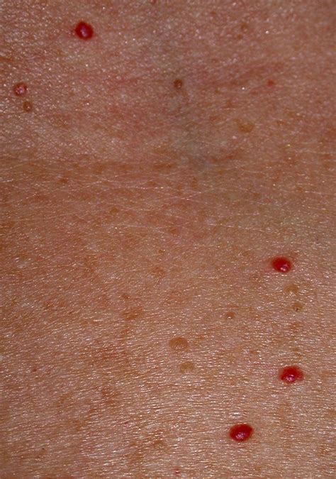 Red Dots On Skin Infection