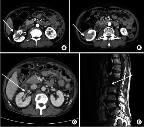 An Abdomino Pelvic Computed Tomography Scan Showed Two Exophytic Renal