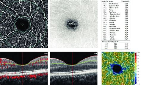 A 3×3 Mm 2 Image Of Superficial Capillary Plexus Angiogram Download