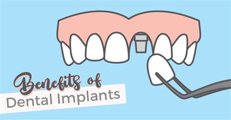 3 Benefits Of Dental Implants Dr Nima Massoomi Dmd Med Md