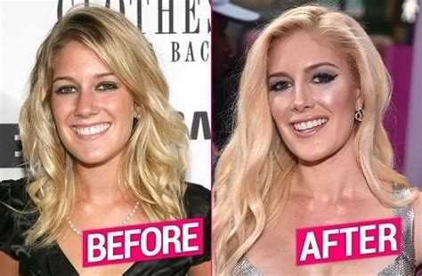Heidi Montag Plastic Surgery Transformations Before And After