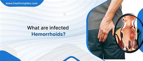 Prolapsed Hemorrhoids Symptoms Causes And Treatment 47 Off