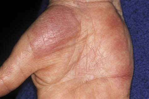 Figure 2 From [acral Lichen Sclerosus Et Atrophicus] Semantic Scholar