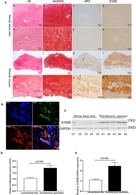 Frontiers Role Of Neutrophil Derived S100b In Acute Myocardial
