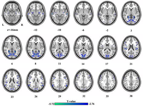 Frontiers Alterations Of Functional Connectivity In Stroke Patients
