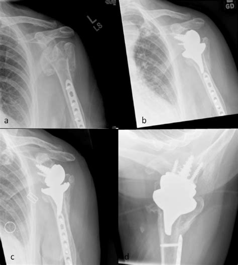 Acute Surgical Management Of Proximal Humerus Fractures Orif Vs Sexiz Pix
