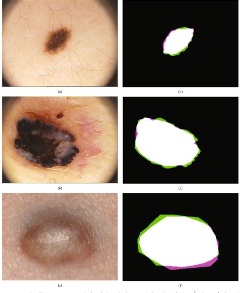 Figure 6 From A Segmentation Of Melanocytic Skin Lesions In Dermoscopic