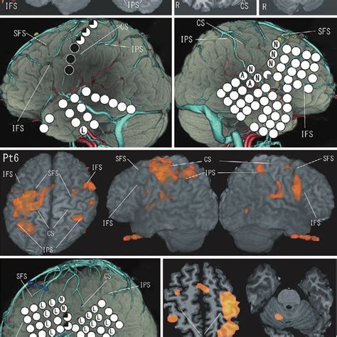 Fmri During A Motor Task And Ecs Mapping In Pts 5 And 6 Bold