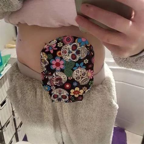 Crohns Sufferer Turns Illness Into Business After Making Fashionable
