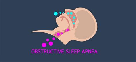 The 2 Main Types Of Sleep Apnea Explained：obstructive And Central 33rd