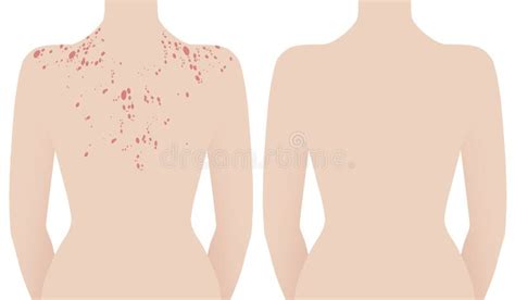 Psoriasis Healthy And Unhealthy Hand Dermatology The Concept Of