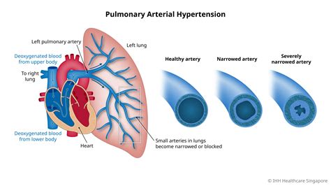 Pulmonary Arterial Hypertension Causes And Symptoms Parkway East