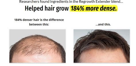 Best Hair Loss Treatments For Men Proven Ways To Regrow Hair