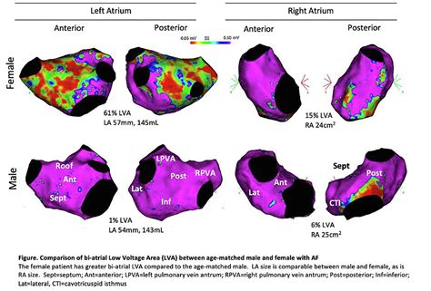 Sex Differences In Atrial Fibrillation And Atrial Structural