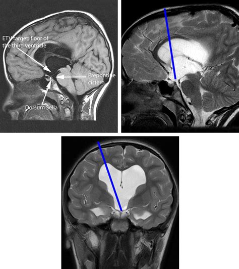 Endoscopic Third Ventriculostomy The Neurosurgical Atlas