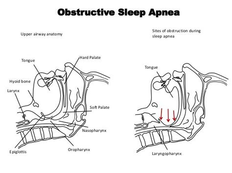 Obstructive Sleep Apnea Pathophysiology