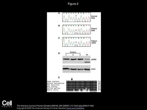 A Heterozygous Truncating Mutation In Rrm2b Causes Autosomal Dominant