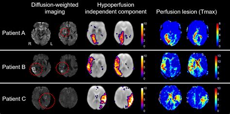 A Novel Approach For Assessing Hypoperfusion In Stroke Using Spatial