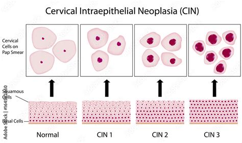 Cervical Dysplasia Stages And Pap Smear Test Stock Illustration Adobe