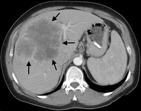 Cureus Successful Management Of An “unresectable” Intrahepatic