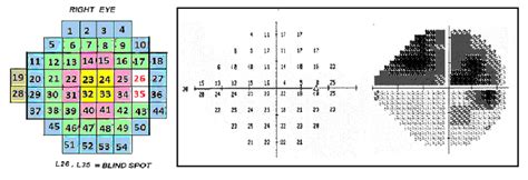 the numeric chart of the hfa visual field output middle and the