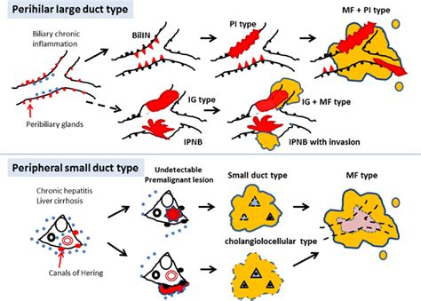 Pathogenesis And Classification Of Intrahepatic Cholangiocarcinoma