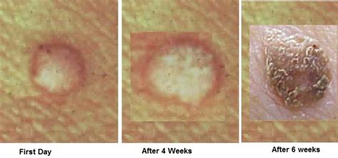 Seborrheic Keratosis Pictures Symptoms Treatment Removal And