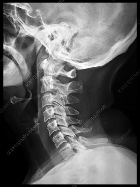 Normal Cervical Spine X Ray Stock Image C039 4054 Science Photo