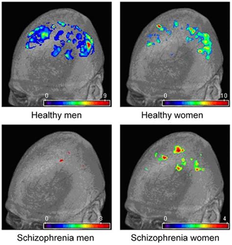 Voxel Based Morphometry Vbm Analysis Of Parietal Gray Matter