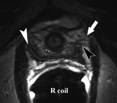 Mr Imaging Of The Female Urethra And Supporting Ligaments In Assessment