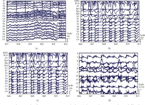 Figure 1 From Detecting Epileptic Seizure From Scalp Eeg Using Lyapunov