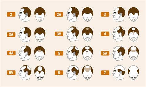 Stages Of Hair Loss Myhair