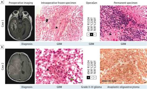 Sensitive Detection Of Glioma Specific Somatic Variants Within An