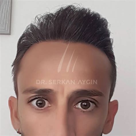 Haartransplantation Türkei Ergebnisse Dr Serkan Aygin Clinic