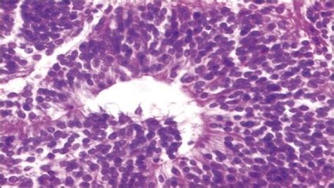 Immature Neuroepithelium Seen In The Form Of Neuroepithelial Rosettes