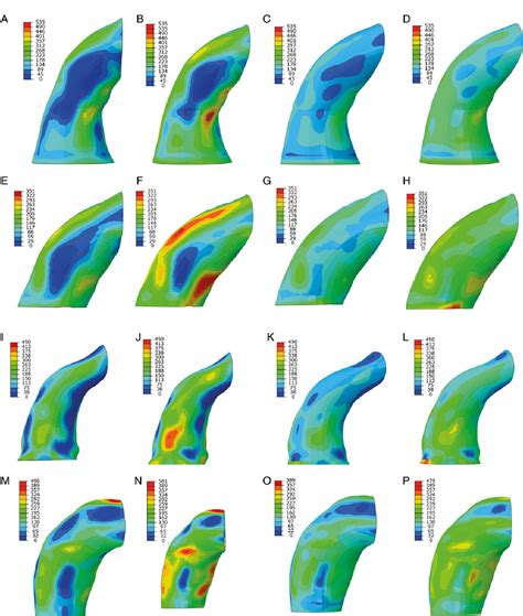 Figure 1 From Ascending Thoracic Aortic Aneurysm Wall Stress Analysis