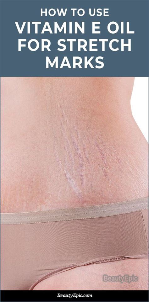 How To Use Vitamin E Oil To Get Rid Of Stretch Marks Oil For Stretch