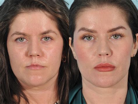 Before And After Jesse E Smith Md Facs Ft Worth Colleyville Facial