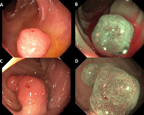 suboptimal endoscopic cancer recognition in colorectal lesions in a