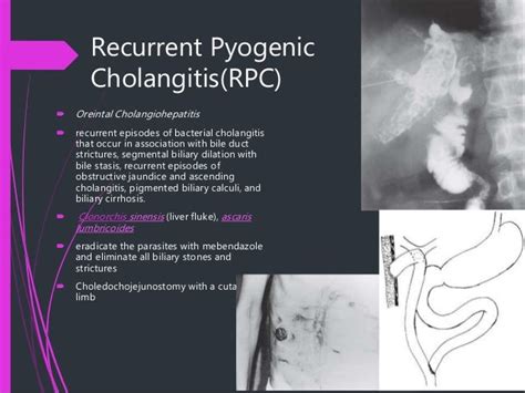 Cholangitis