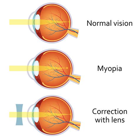 Understanding Refraction And Refractive Errors – Eyewa Blog