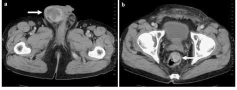 Computed Tomography Ct Scan Of The Patient A Contrast Enhanced Ct