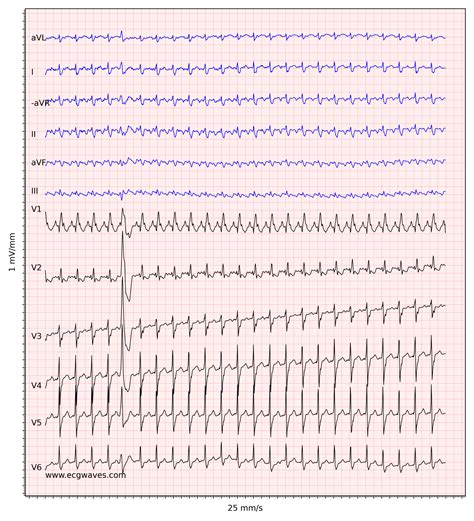 Atrial Flutter Classification Causes Ecg Diagnosis And Management