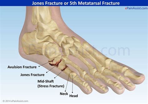 The 3 Types Of Fifth Metatarsal Fractures – Artofit
