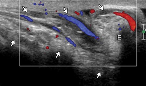 Us Of The Inguinal Canal Comprehensive Review Of Pathologic Processes
