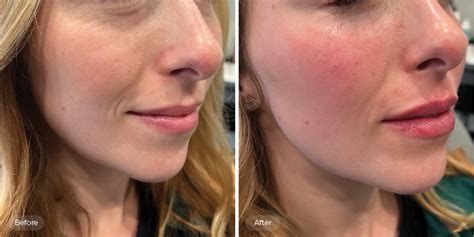 Say Goodbye To Under Eyes Tear Troughs With Dermal Fillers Treatment In
